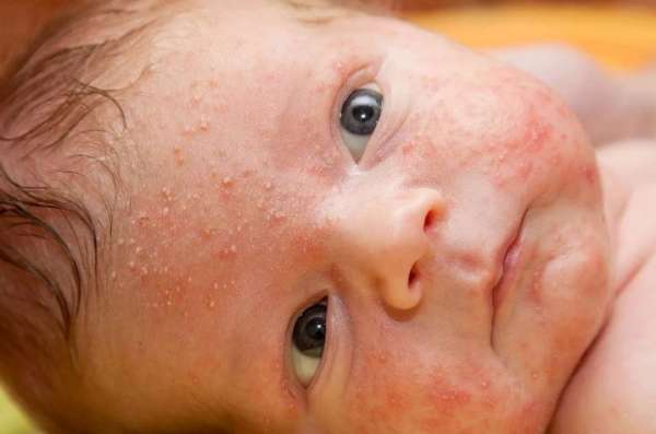 Аллергические высыпания на коже у взрослых и детей (фото): лечение сыпи
